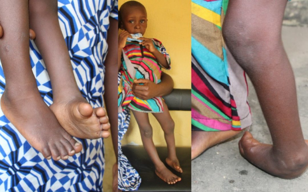 Excellent Undergoes Clubfoot Correction Procedures - Hosanna David ...
